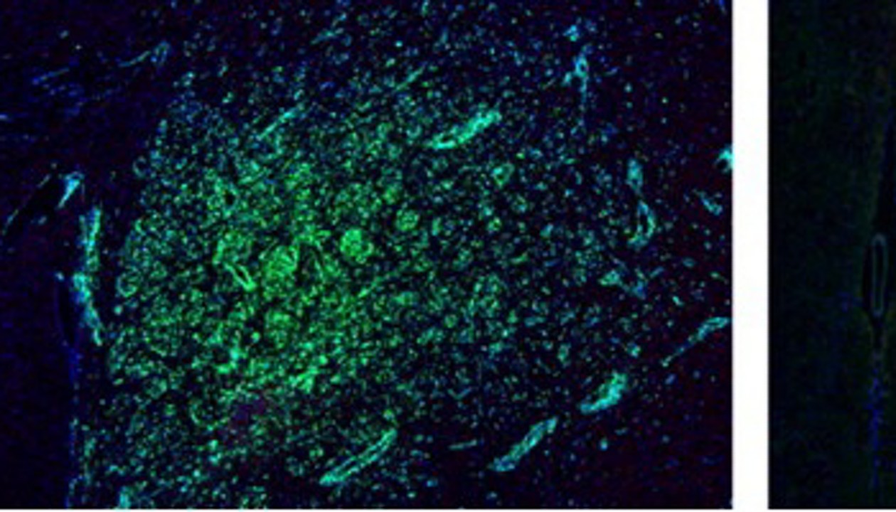 Polymer Nanoparticles Deliver Genes To Brain Tumor Cells