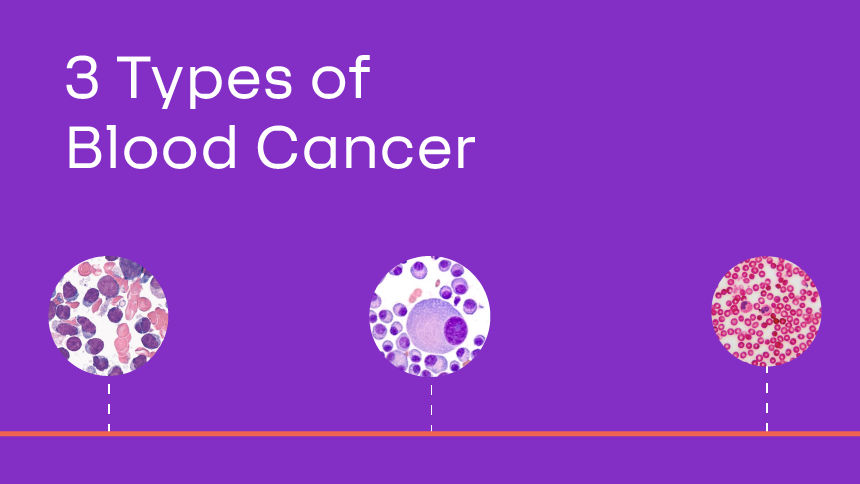 Then and now: A renaissance in blood cancer treatment | AbbVie