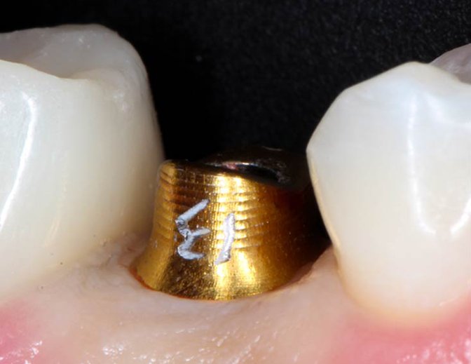 Clinical Case: A Closer Look at RMGI Dental Cement for an Implant ...