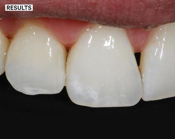 Clinical Case: 21st-century Class III Restoration Using a Bioclear ...