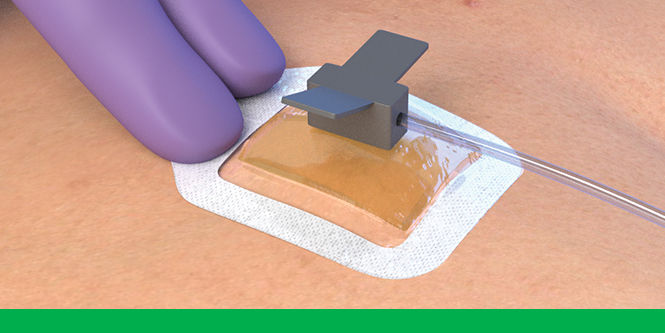 3M™ Tegaderm™ CHG Chlorhexidine Gluconate Gel Pad | Solventum