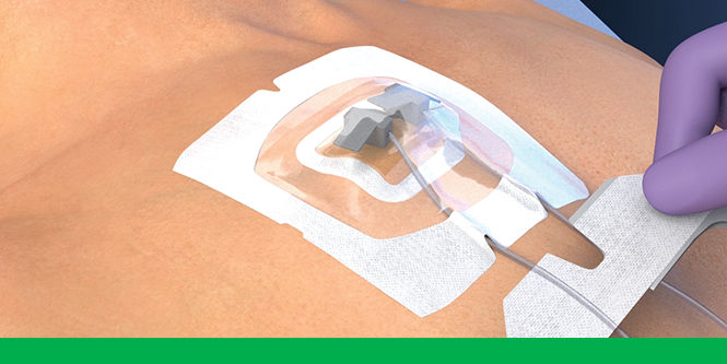 3M™ Tegaderm™ CHG Chlorhexidine Gluconate Gel Pad | Solventum