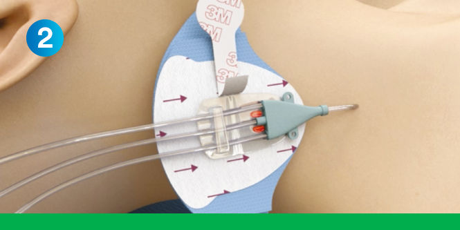 3M™ PICC/CVC Securement Device + 3M™ Tegaderm™ CHG Chlorhexidine ...