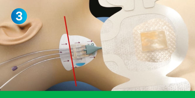 3M™ PICC/CVC Securement Device + 3M™ Tegaderm™ CHG Chlorhexidine ...