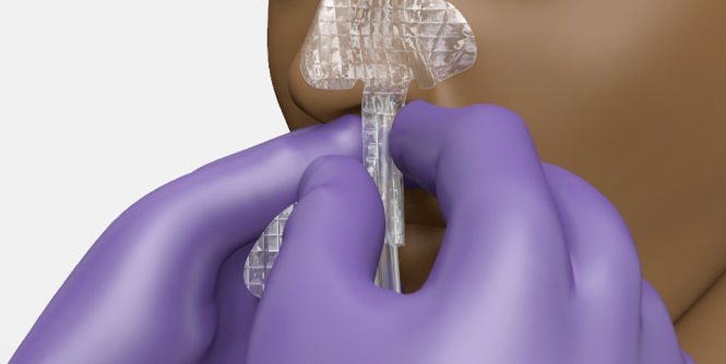 3M™ Nasogastric Securement Device | Solventum