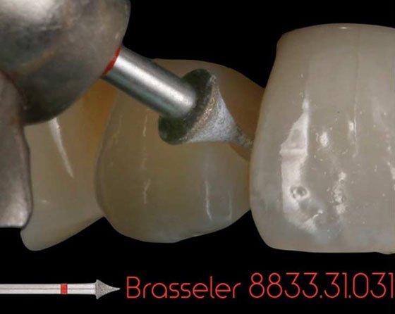 Clinical Case: 21st-century Class III Restoration Using a Bioclear ...